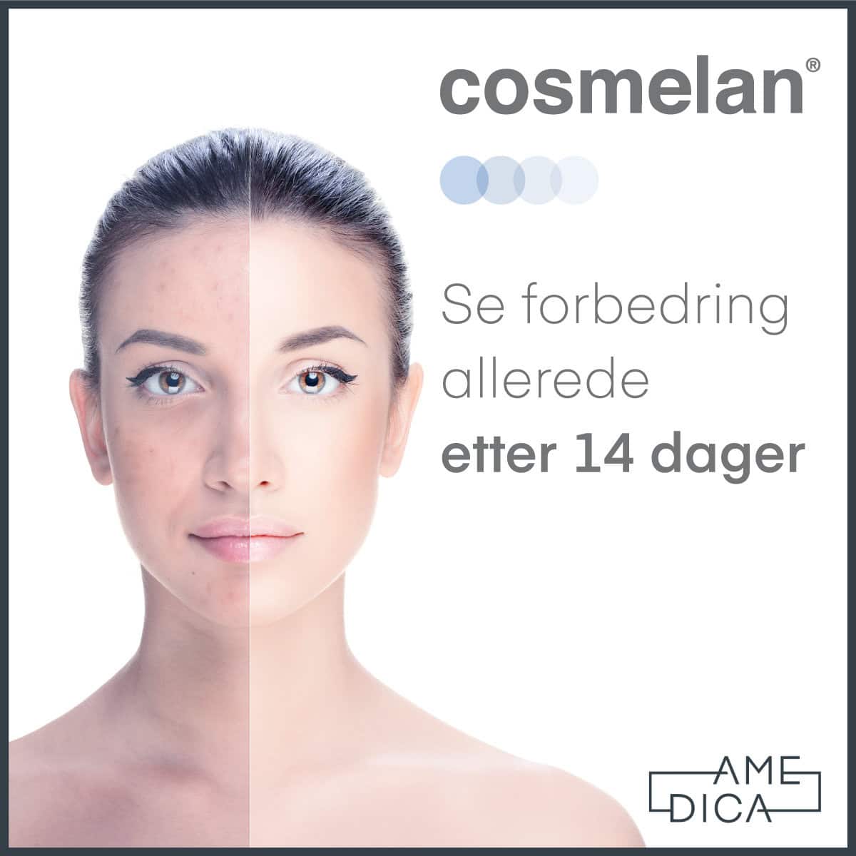 COSMELAN PIGMENT BEHANDLING - Krystall Hud og Velvære
